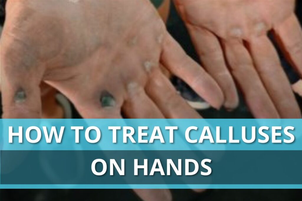 How To Treat Calluses On Hands From Weightlifting At Home 