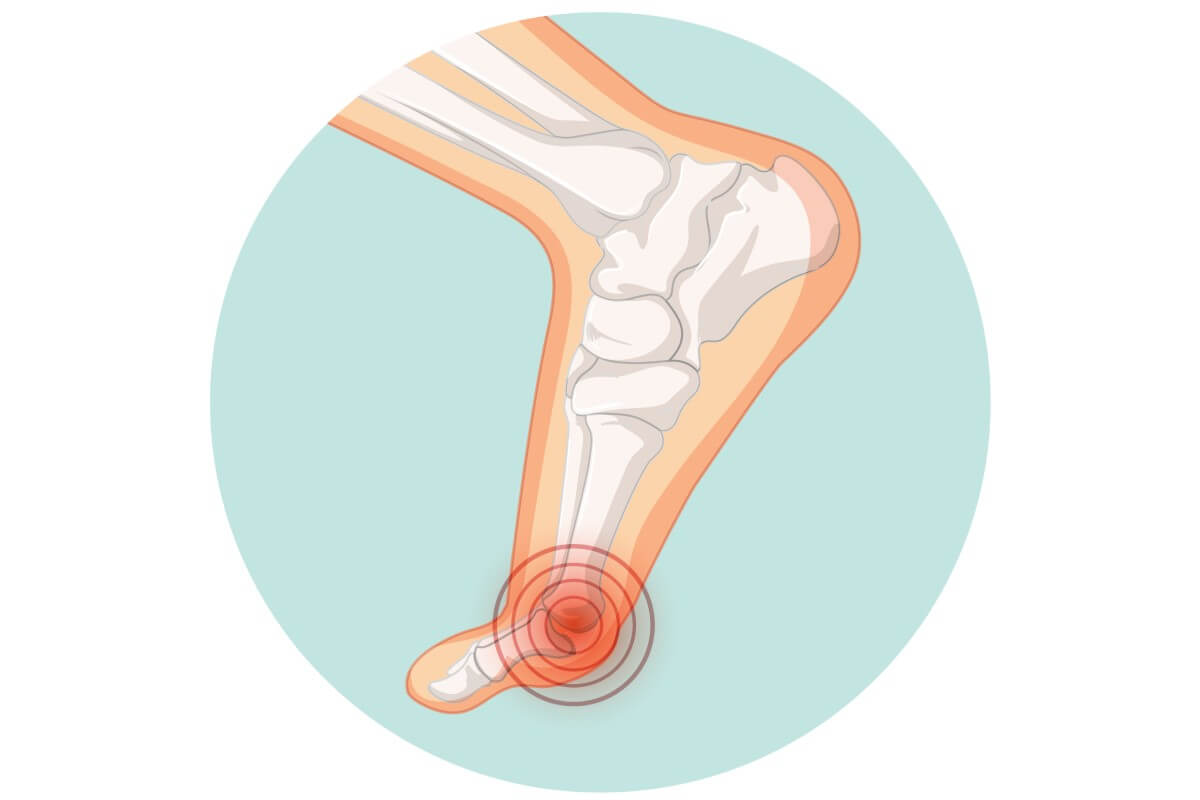 Why Does Big Toe Hurt After Running